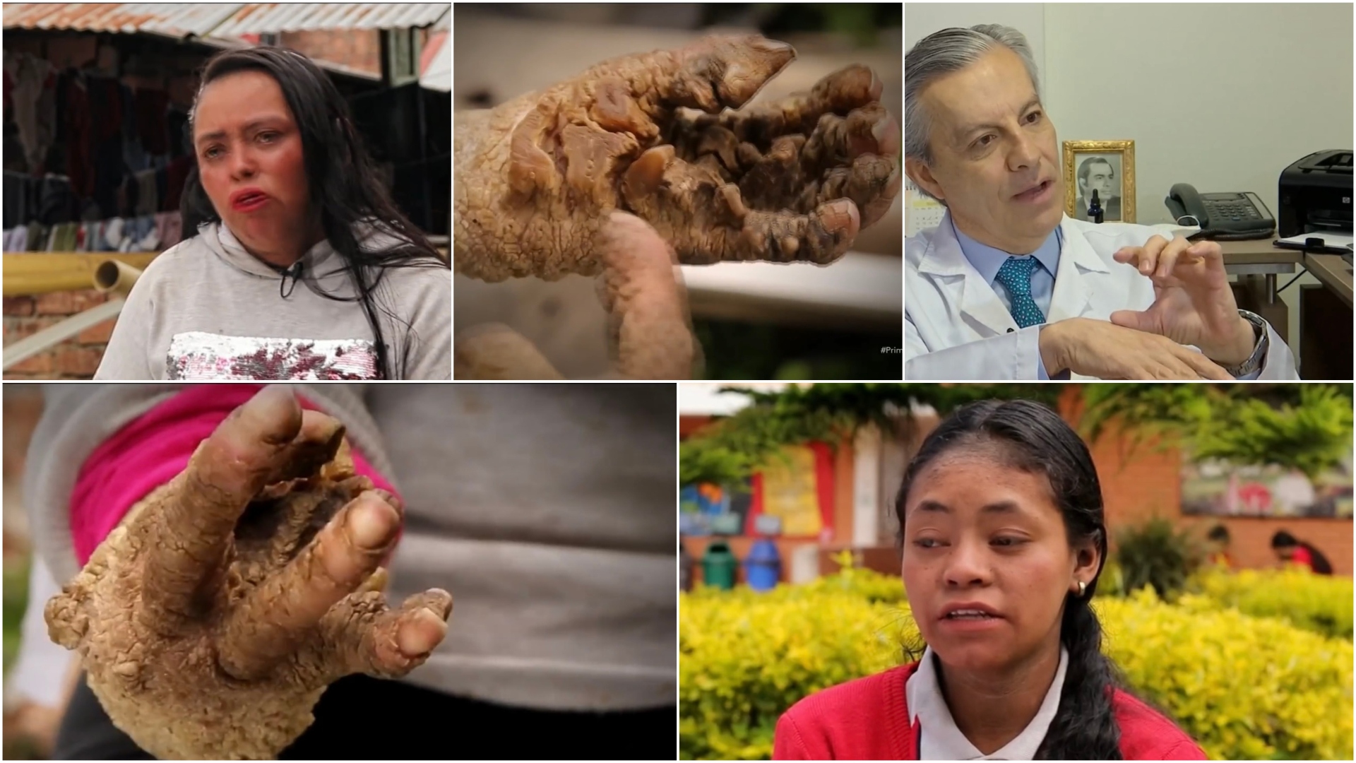 El sufrimiento de una madre e hija por sufrir rara enfermedad que ...