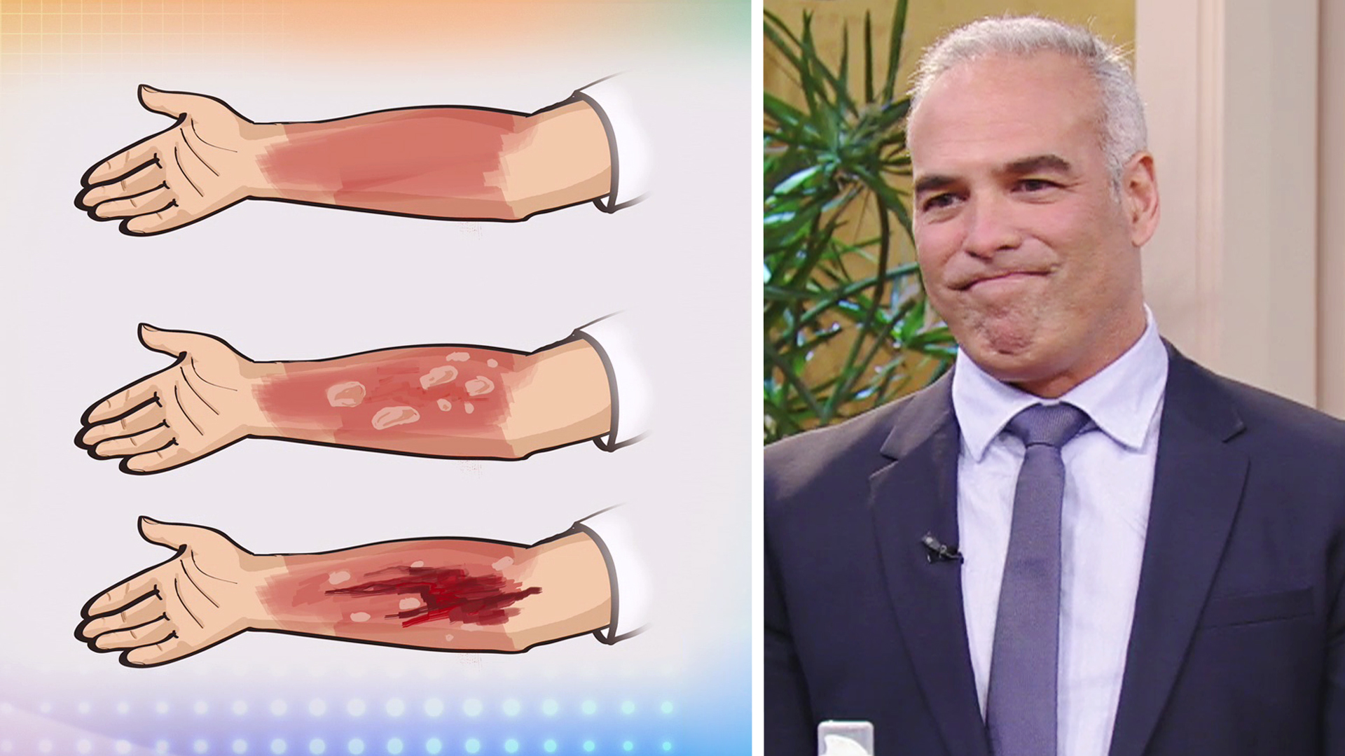 Quemaduras 101: Aprende a prevenirlas y curarlas en casa | Shows ...