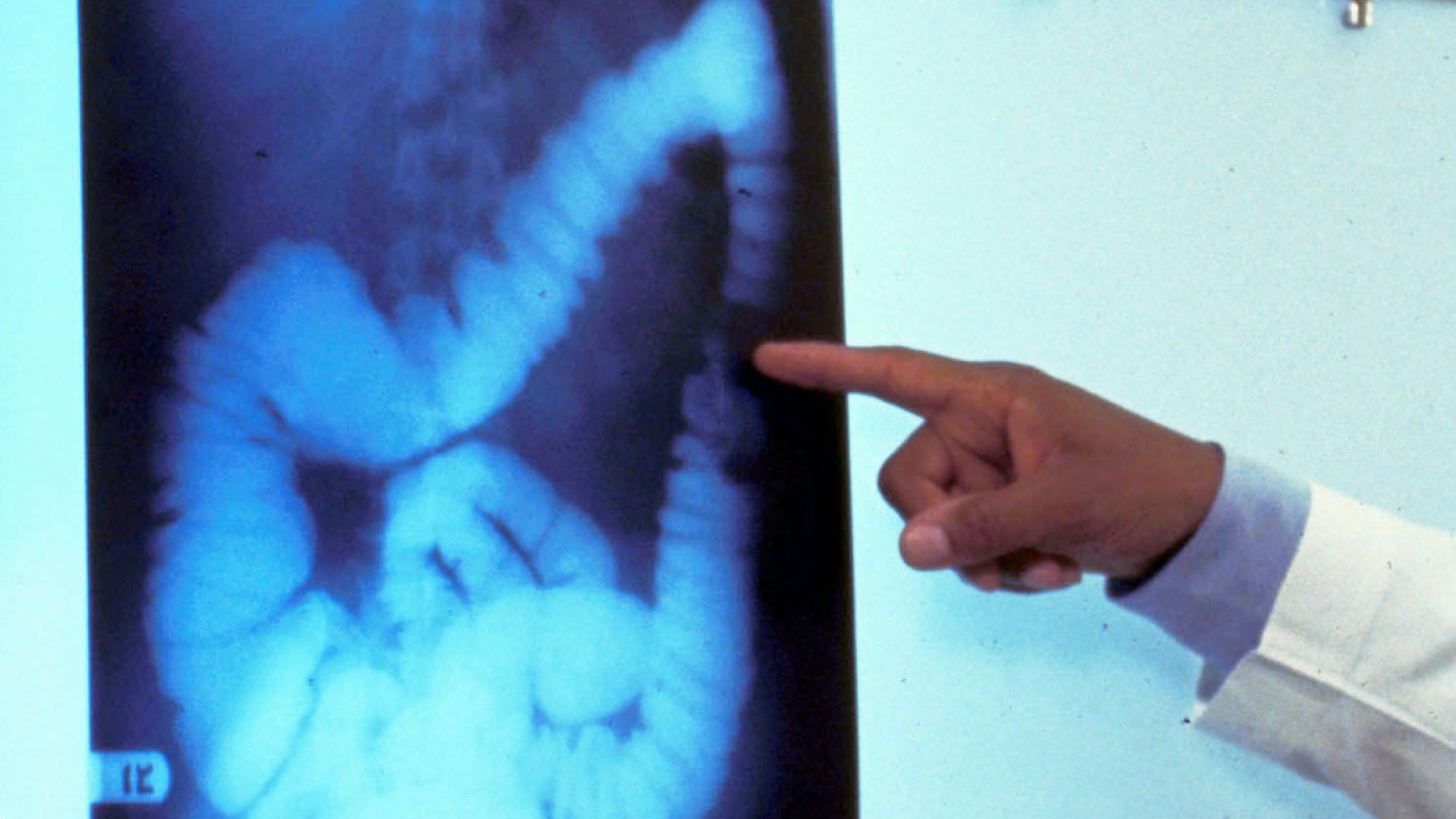 Cáncer de colón: sus causas, los factores de riesgo y cómo prevenirlo ...