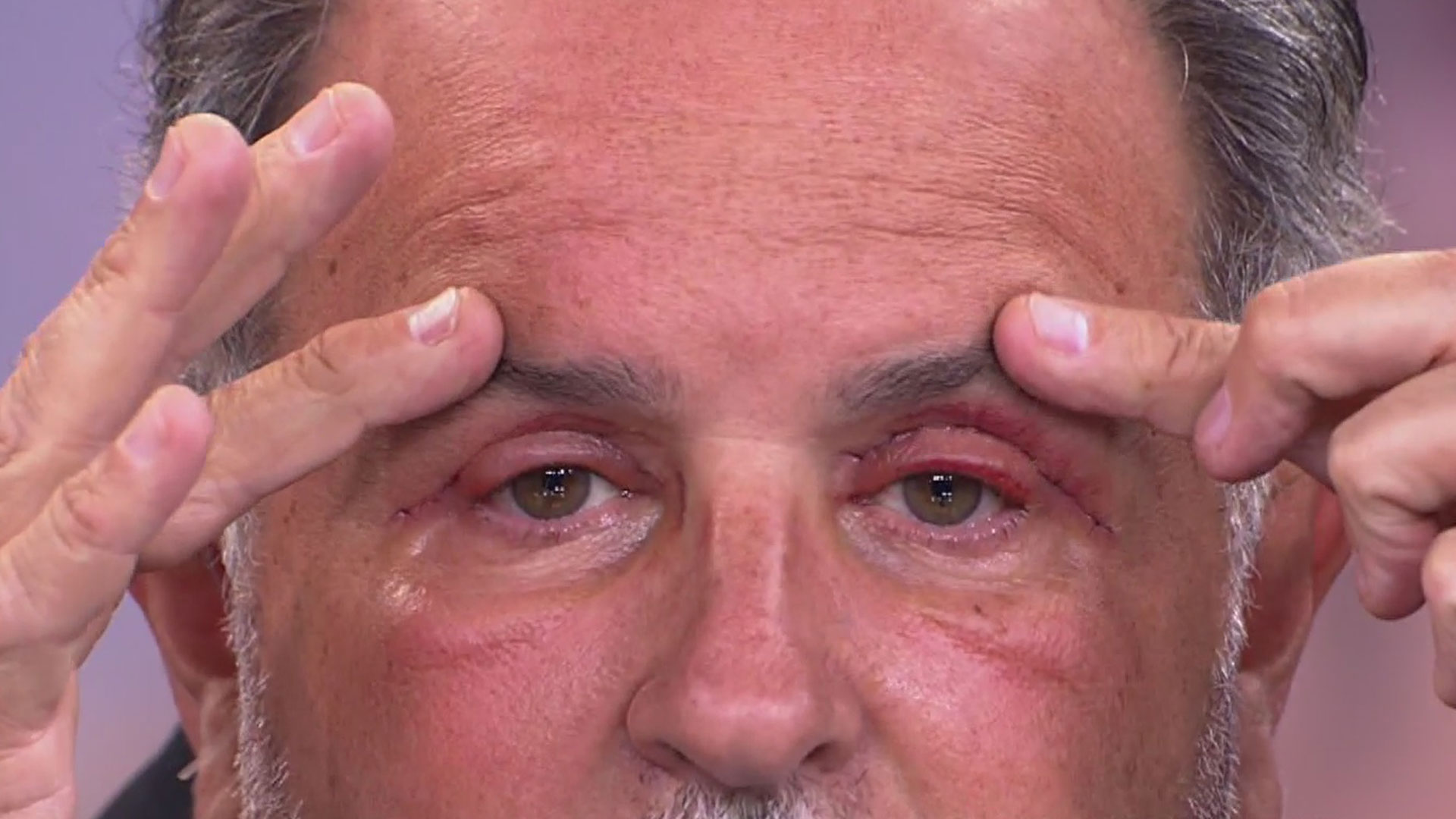 ¿Qué hicieron con la grasita que le quitaron a Raúl de los párpados ...