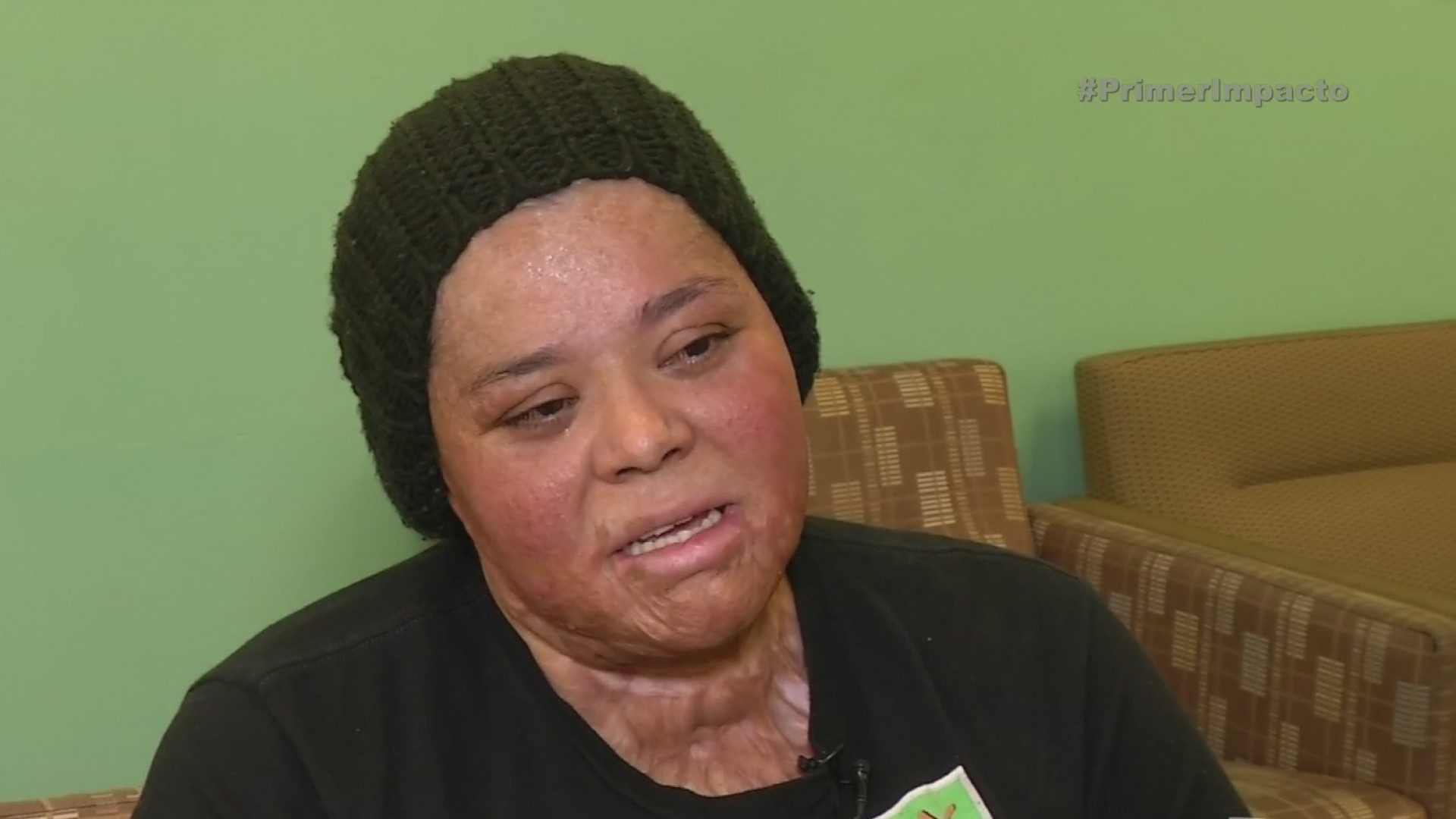 Mujer es quemada por su marido | Shows Primer Impacto | Univision