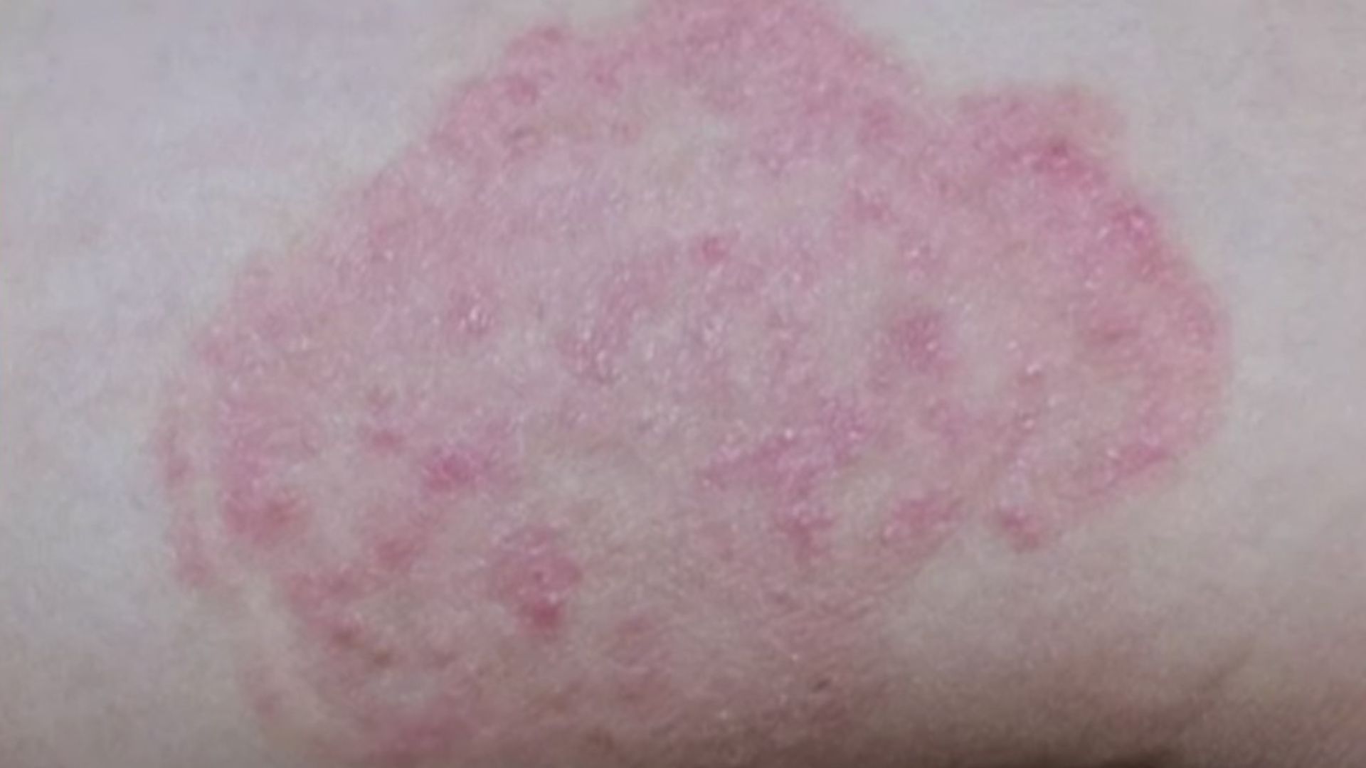 Alertan sobre la tiña, un hongo muy contagioso que está presente en ...