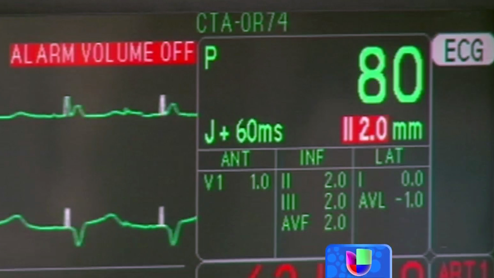 Estudio demuestra que es más probable sobrevivir a un infarto de día ...