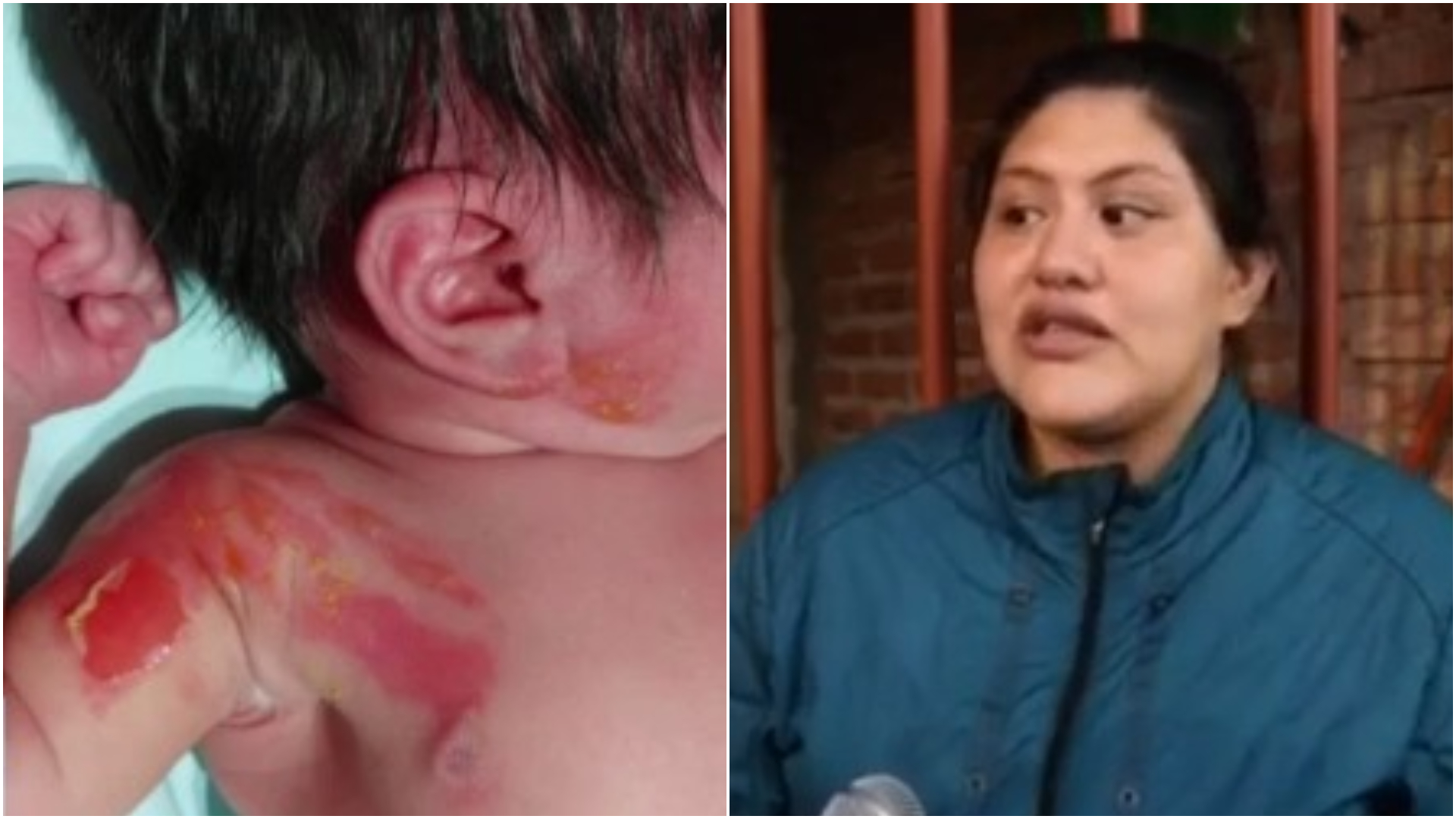 Madre denuncia que su bebé fue quemado con una jeringa en el hospital ...