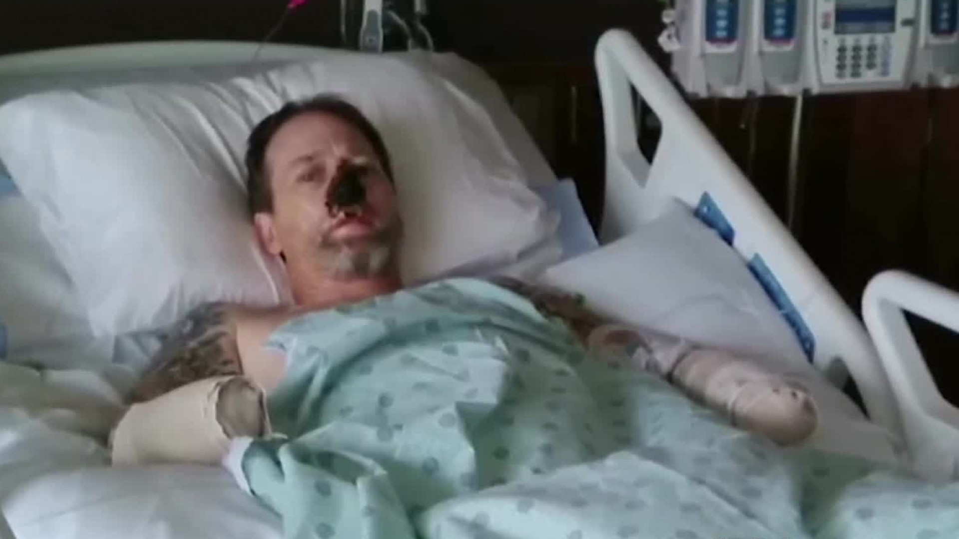 A un hombre le tuvieron que amputar sus extremidades por una bacteria ...