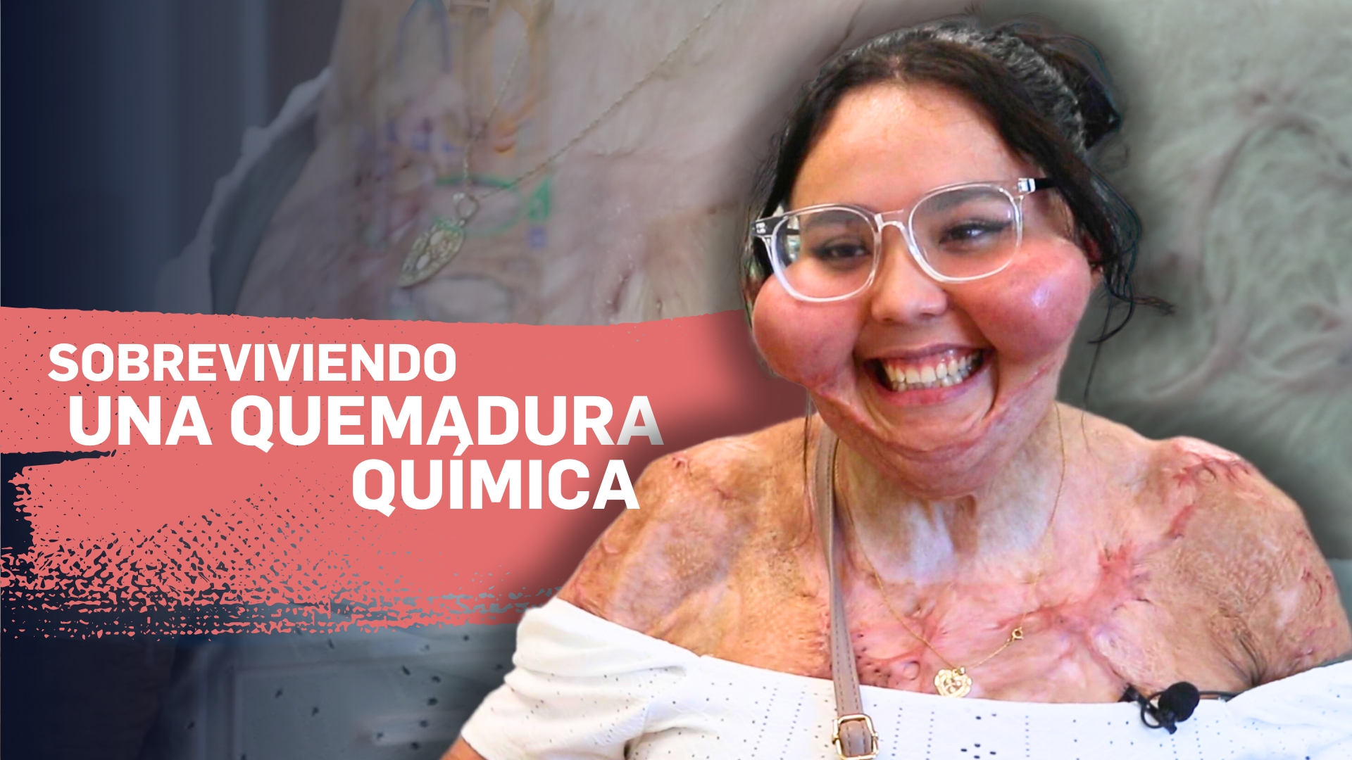 "No me quise ir": Joven mexicana le amputaron las piernas tras quemarse ...