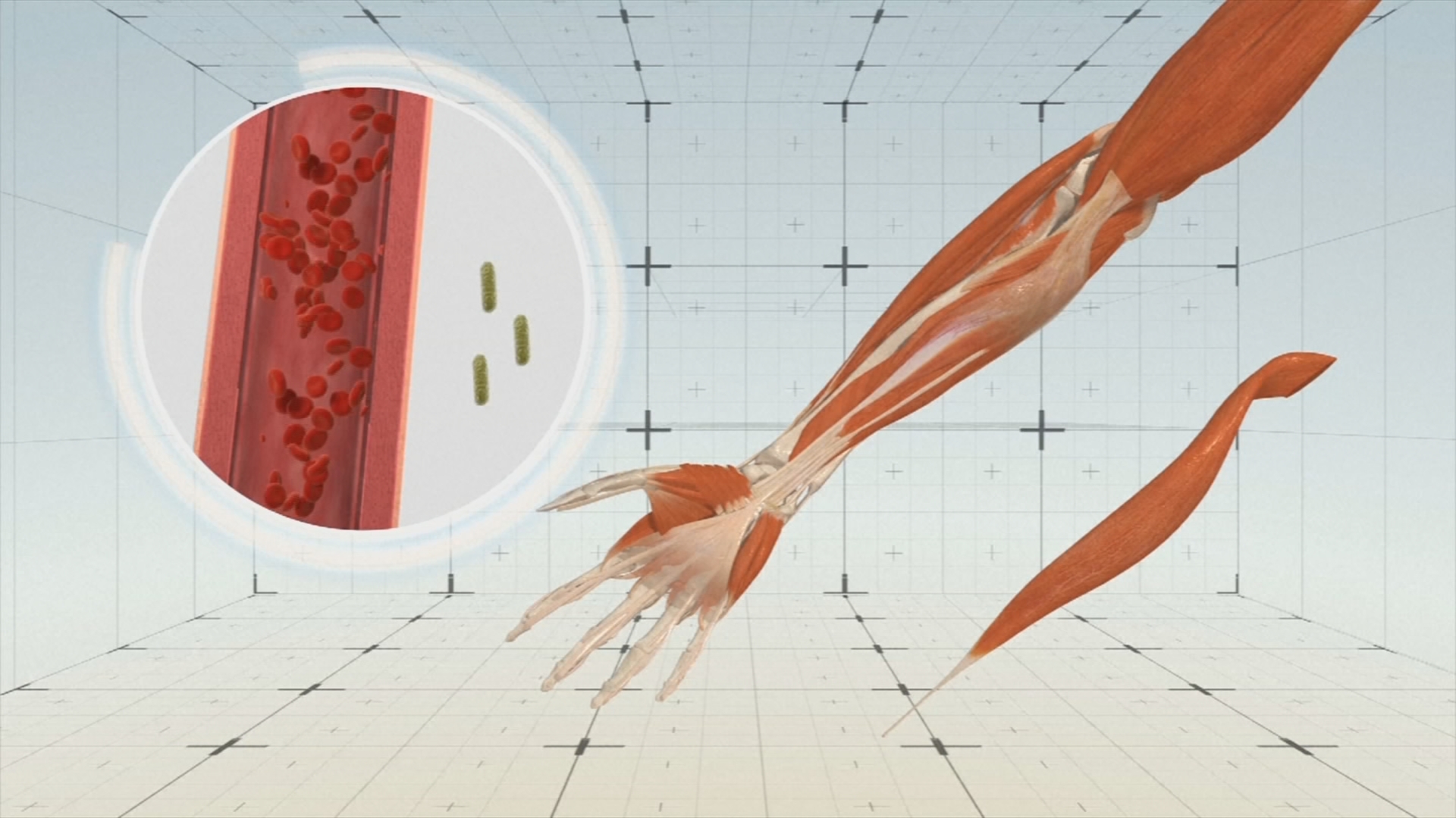 Animación: Las causas y los síntomas de la sepsis | Noticias Univision ...