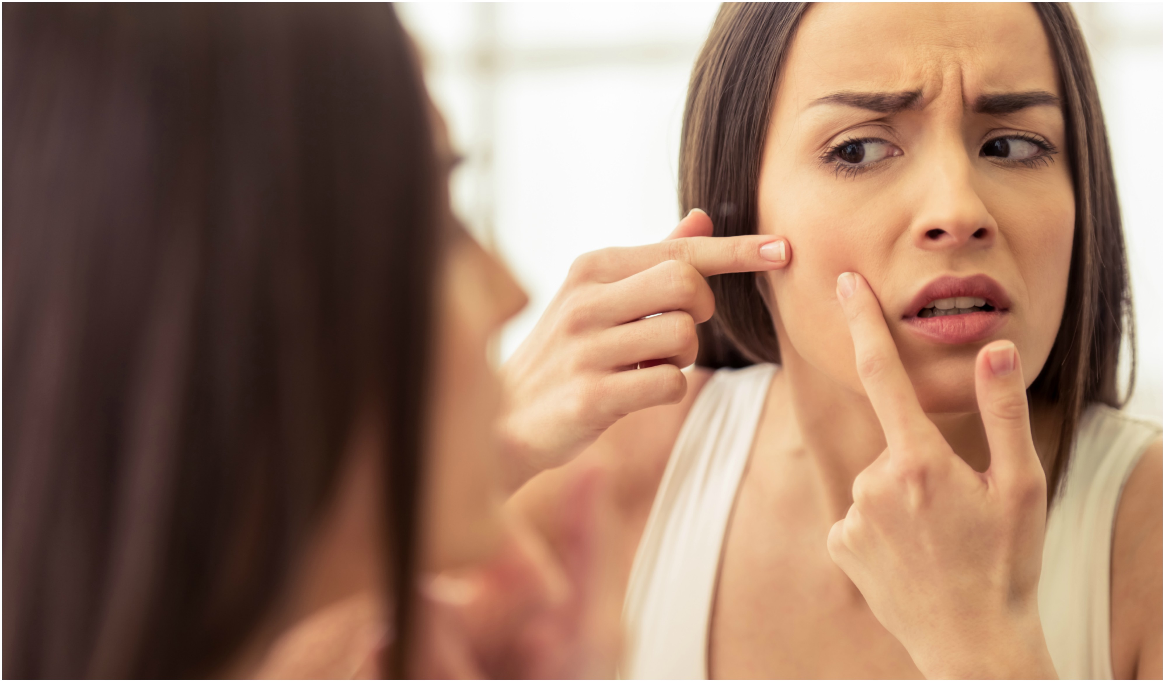 ¿Cómo debo atenderme el acné, me debo pellizcar el rostro? | Univision ...