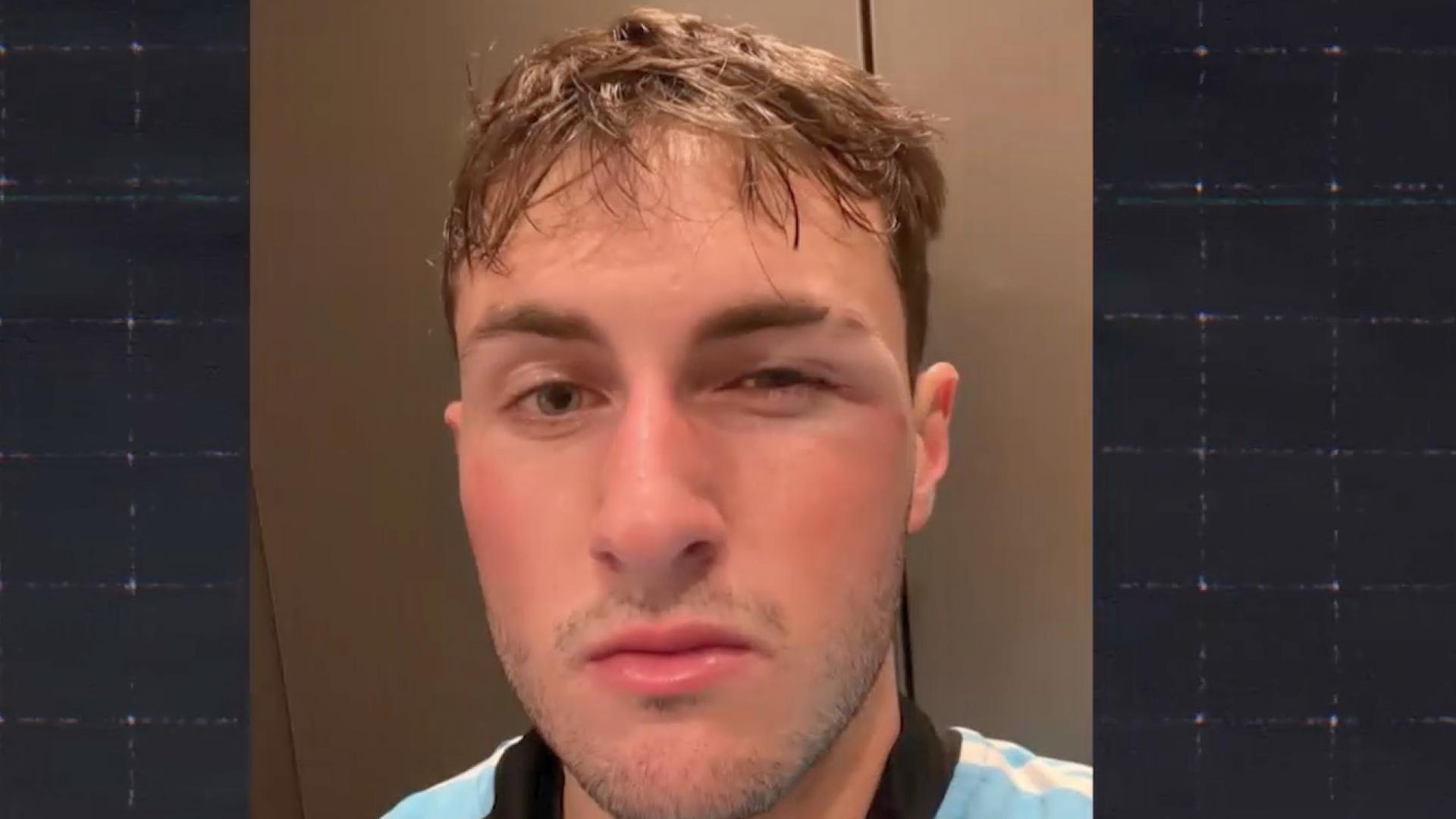 ¿Futbox? 'Santi' Giménez muestra su golpeado ojo izquierdo | Deportes ...