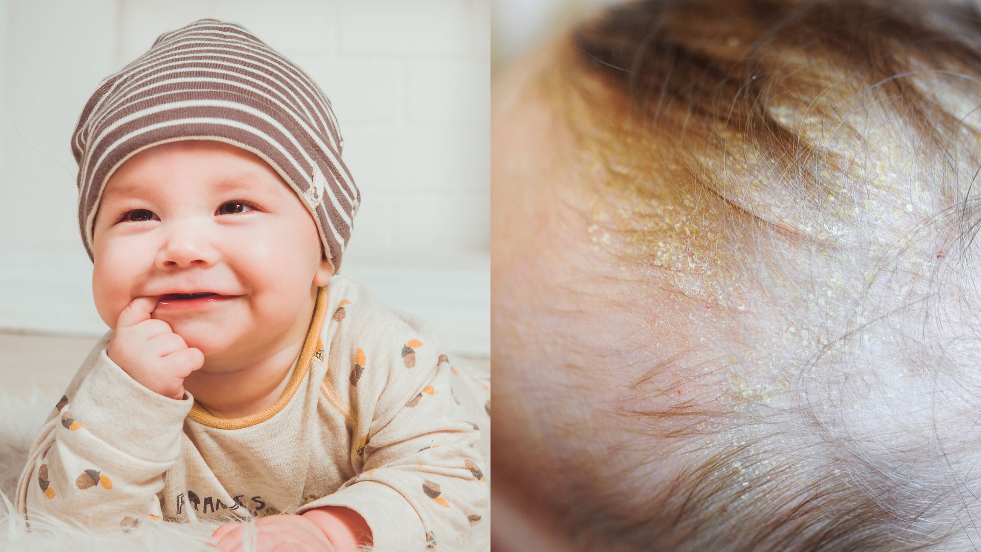 5 consejos que sí funcionan para disminuir la costra láctea en la piel ...