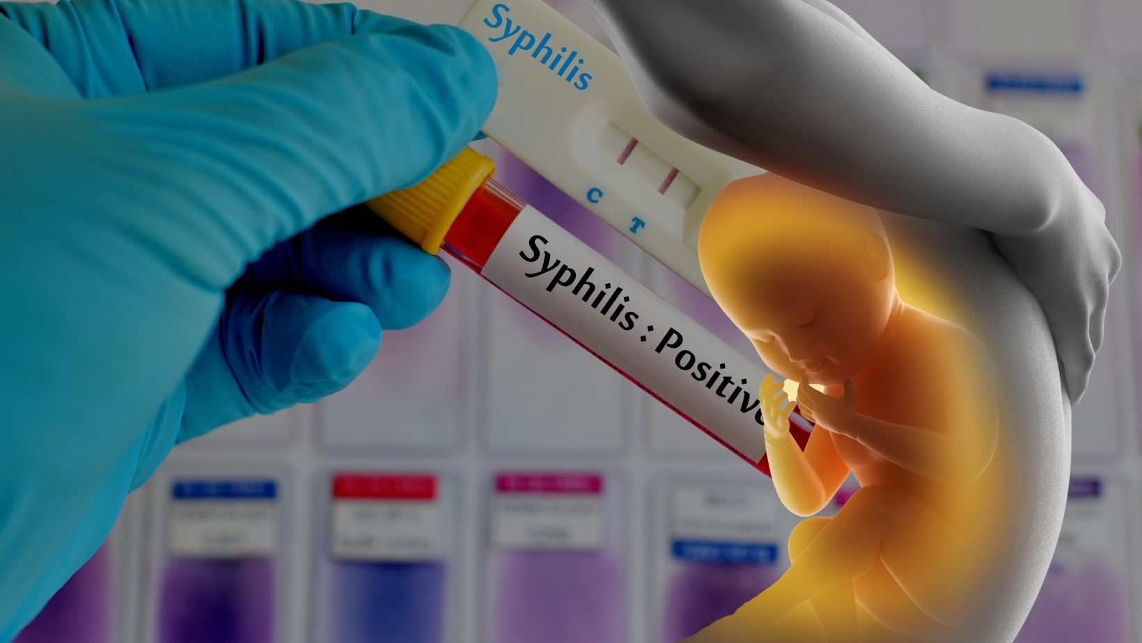 Tasas de sífilis transmitidas a los bebés son las más altas que las ...