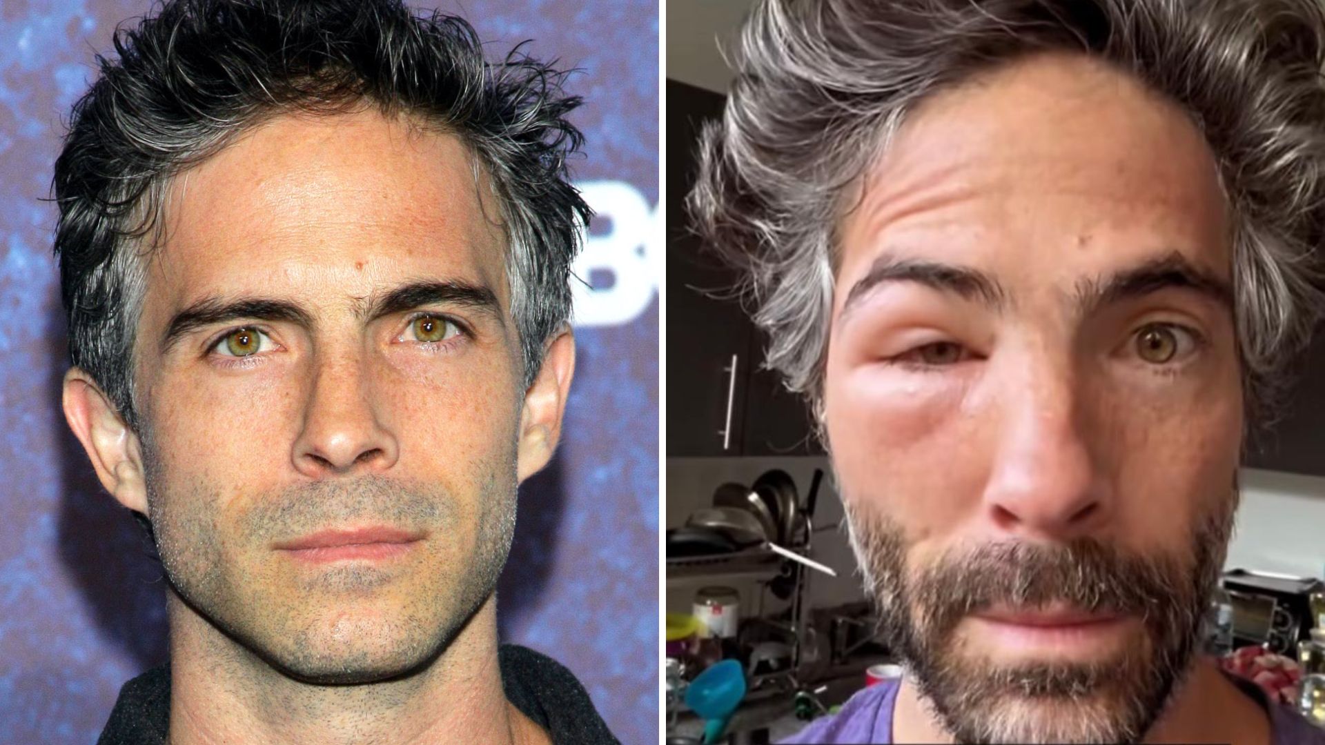 Osvaldo Benavides aparece con la mitad del rostro deformado: ¿qué le pasó? | Univision Famosos ...