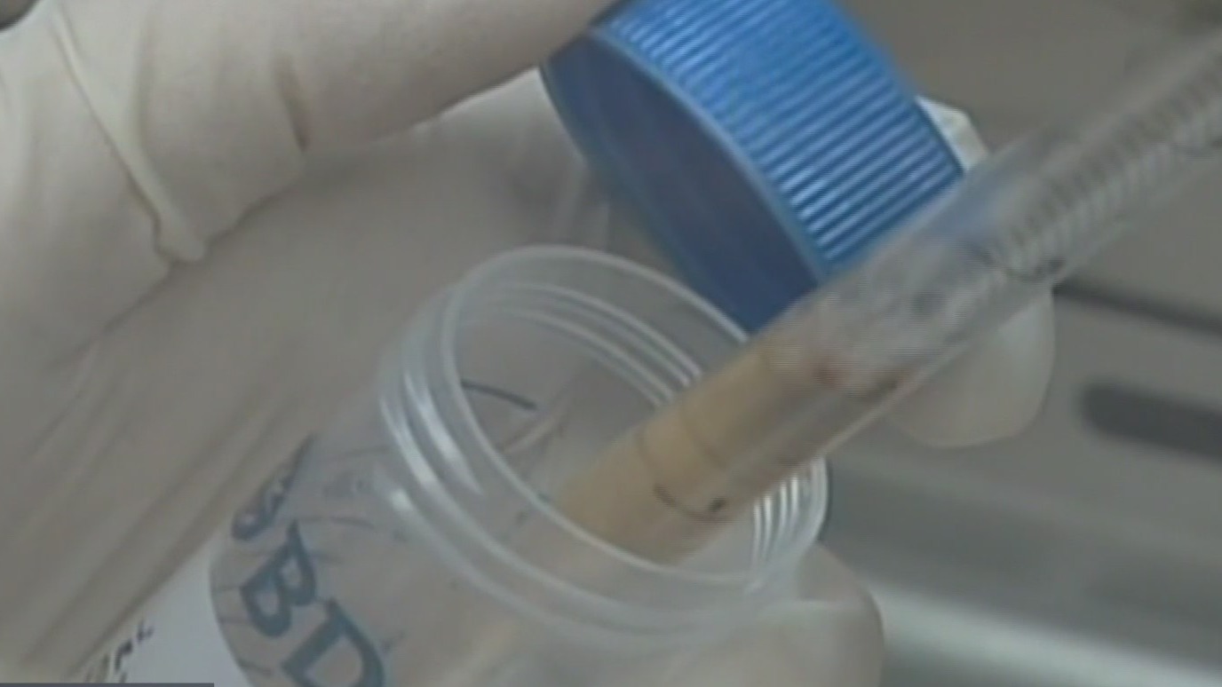 Científicos confirman el caso de la quinta persona curada de VIH ...