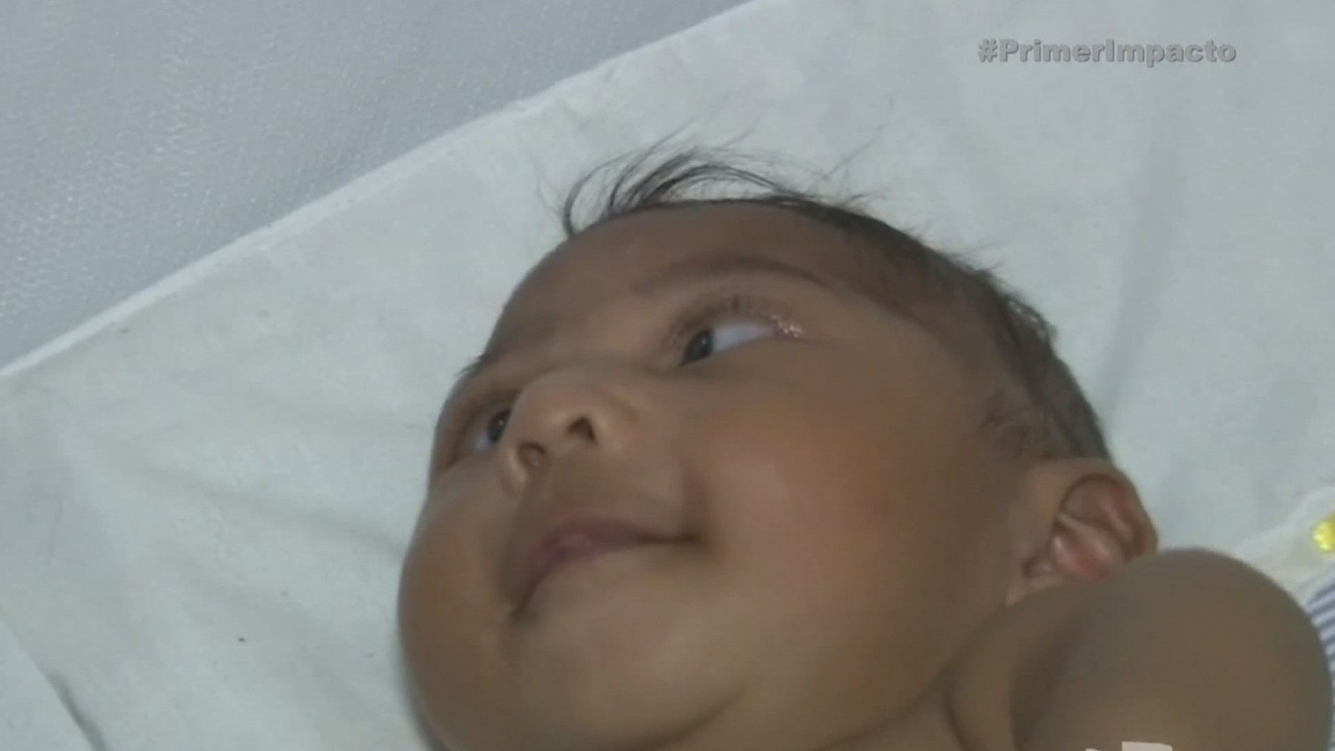 Nació el primer bebé con microcefalia en EEUU | Shows Primer Impacto ...