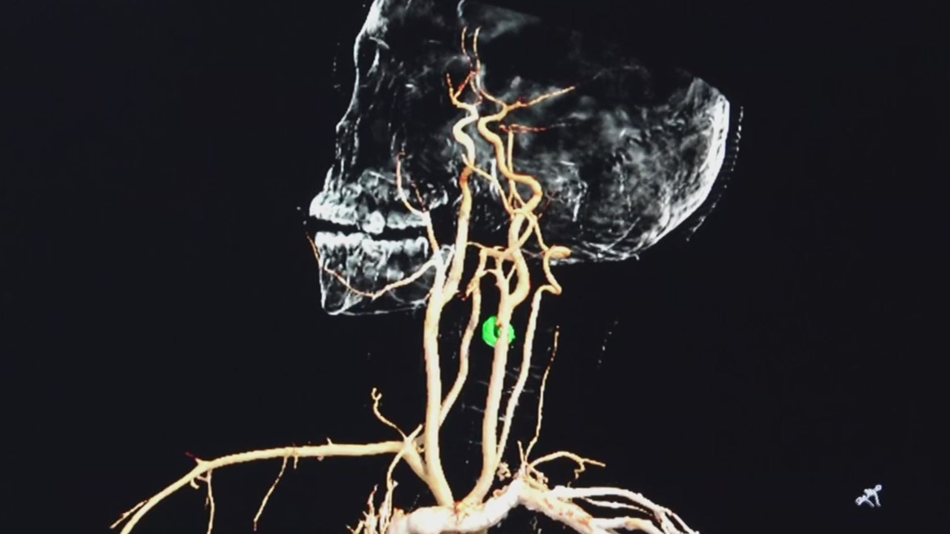 Niña de 9 años sobrevive tras ser impactada por una bala perdida en ...