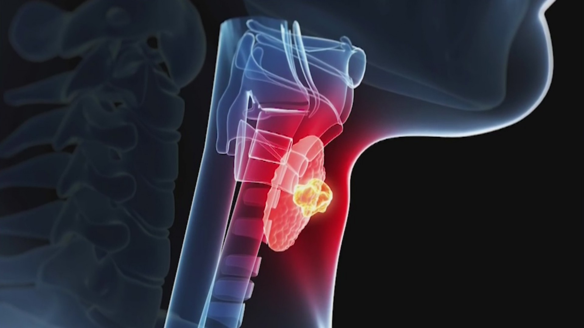 La faringitis, una enfermedad bastante contagiosa que es más común ...
