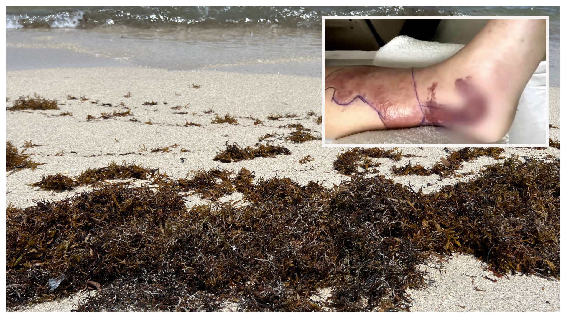 Cuidado: Bacteria come carne estaría presente en el sargazo que invade ...
