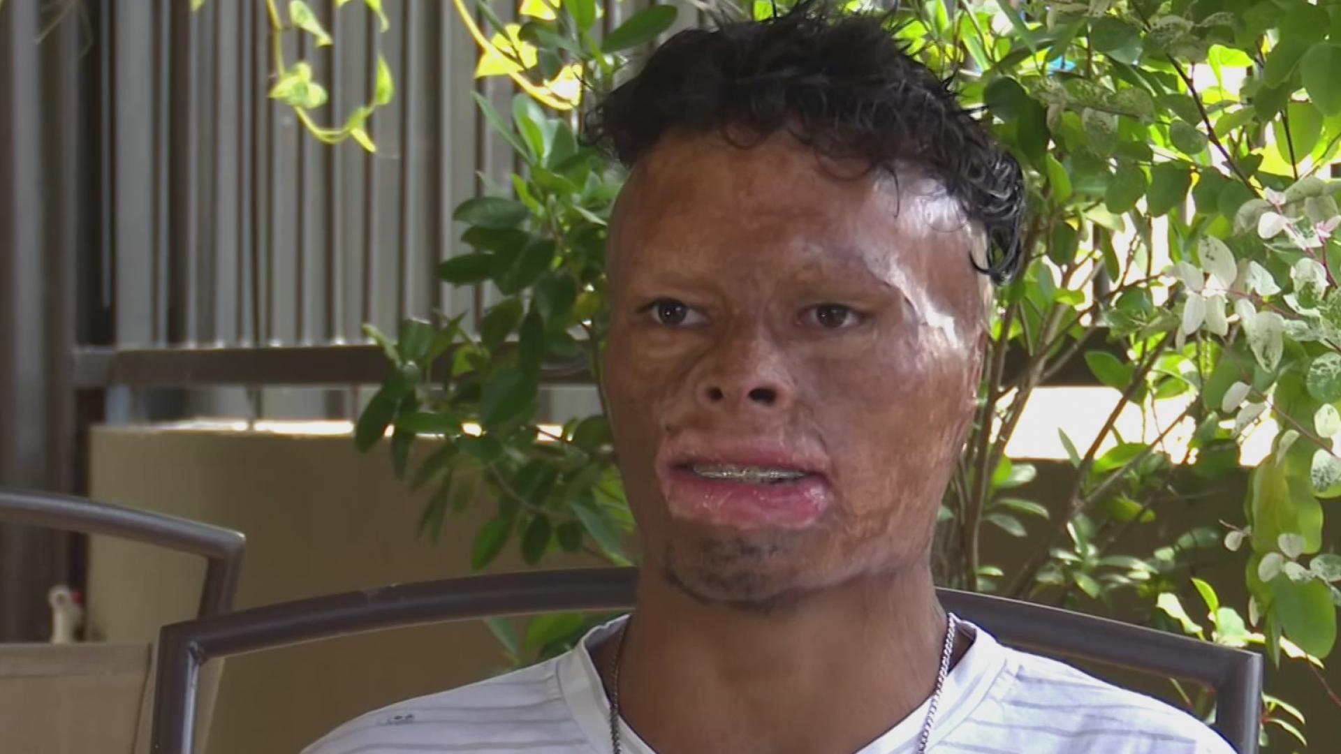 Joven narra cómo su cuerpo quedó quemado en un 97% | Shows Primer ...