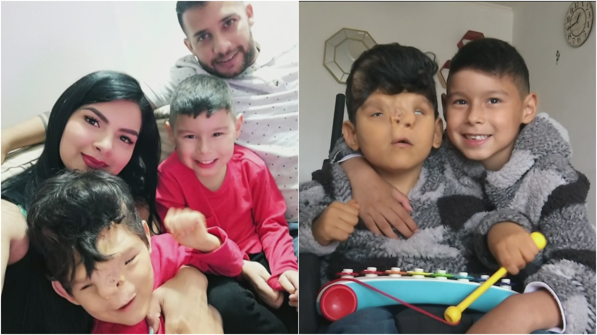 La historia de Thiago, un niño de 6 años que nació con una malformación ...
