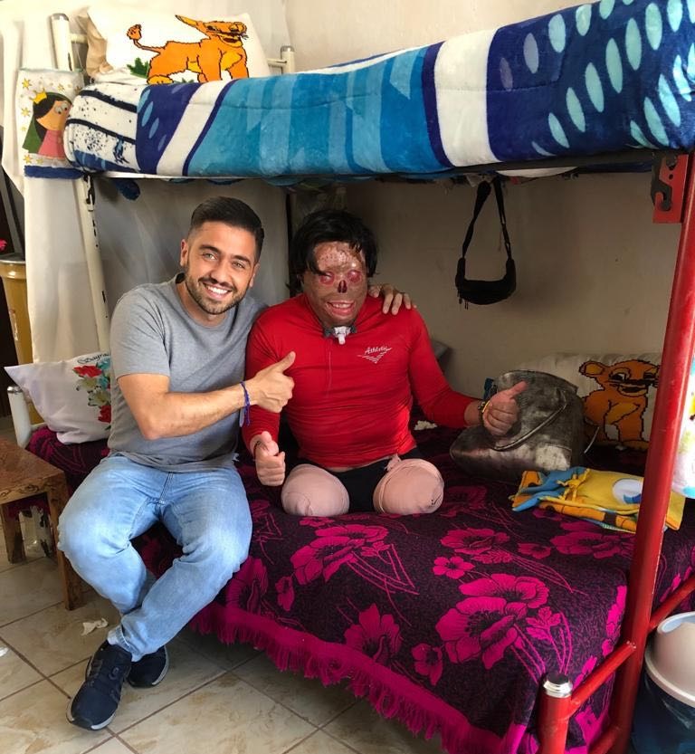 Ayuda de Impacto: Una descarga eléctrica lo dejó desfigurado y ahora ...